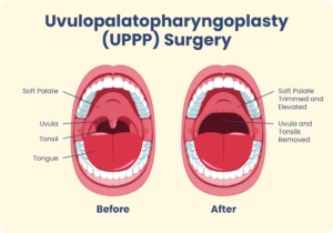 What Is UPPP Surgery?